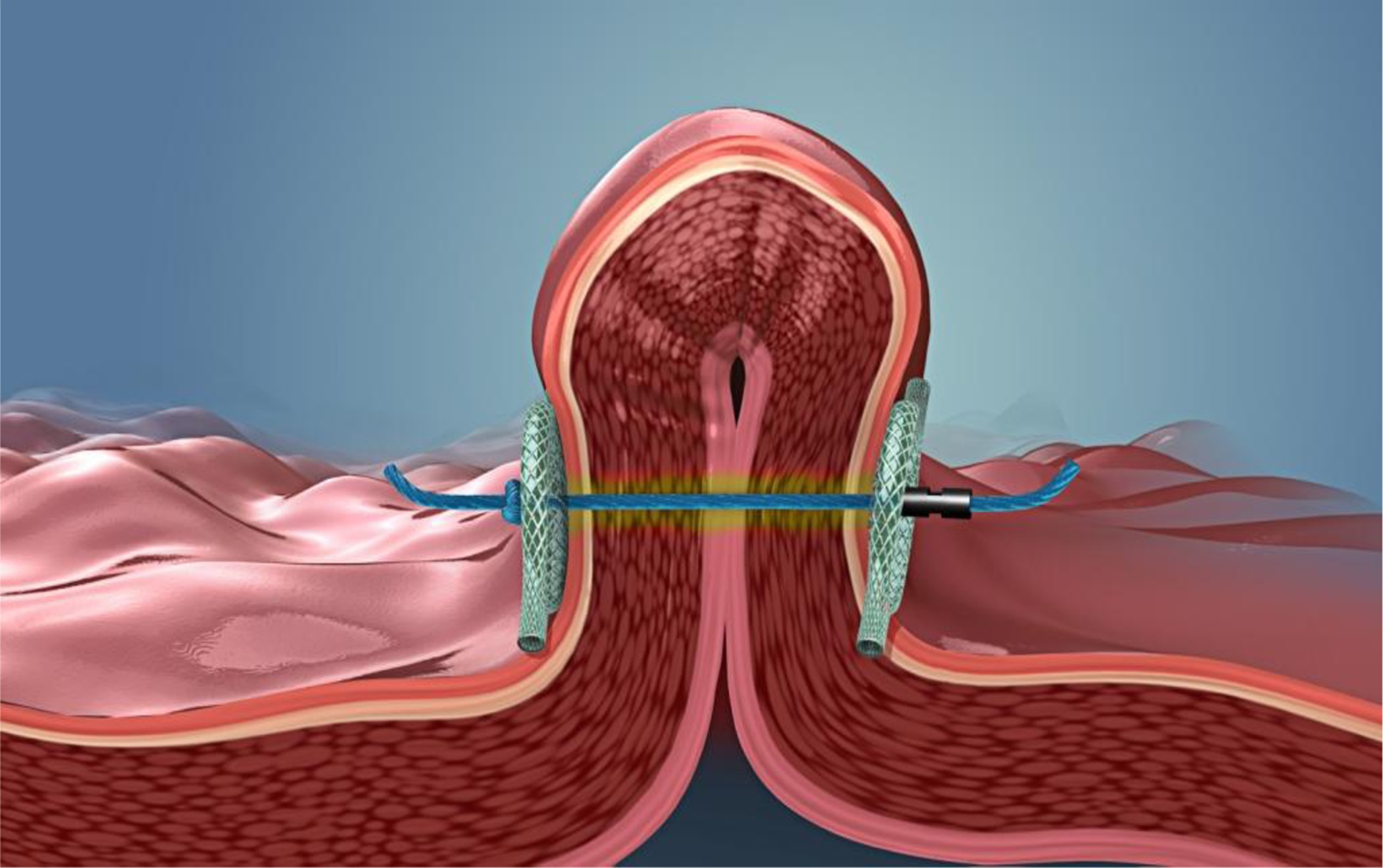 RMS Medical Devices Benelux, Medische apparatuur, Medische producten ...